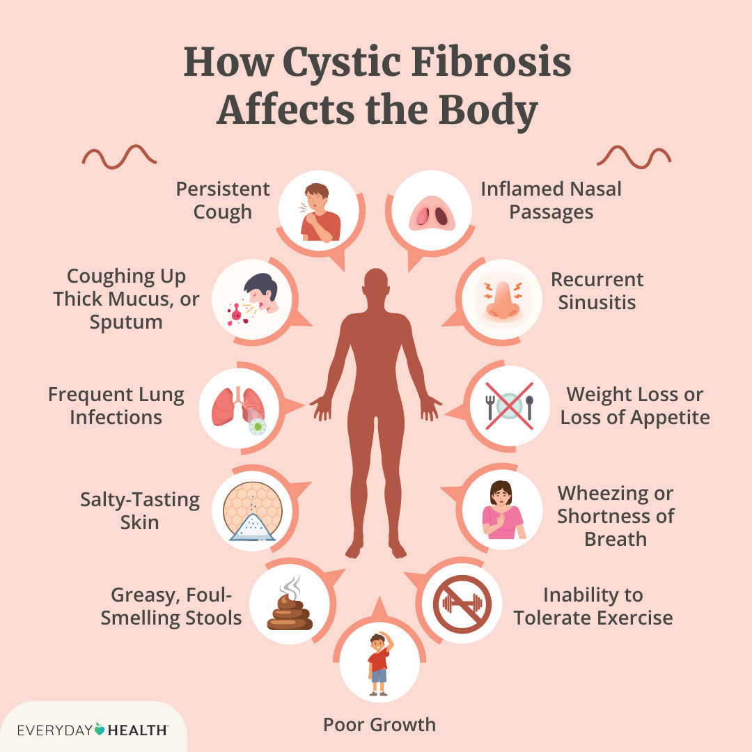 Three times cystic fibrosis gets misdiagnosed in black women - Milwaukee Times Weekly Newspaper